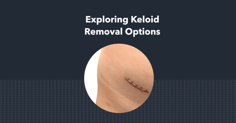 Exploring Keloid Removal Options: From Steroid Injections to Laser ...
