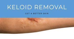The Psychological Impact of Keloid Scarring and How to Cope with It ...