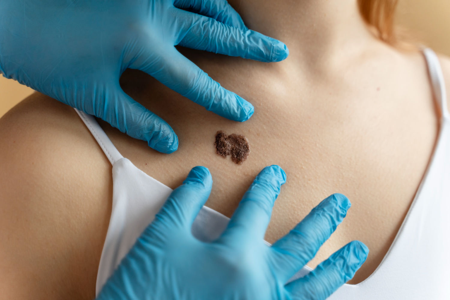 Should Raised Moles Be Removed Read This First Should Raised Moles Be Removed Read This First